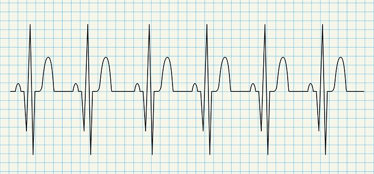 What Does Borderline ECG Mean? Interpretation & Key Causes